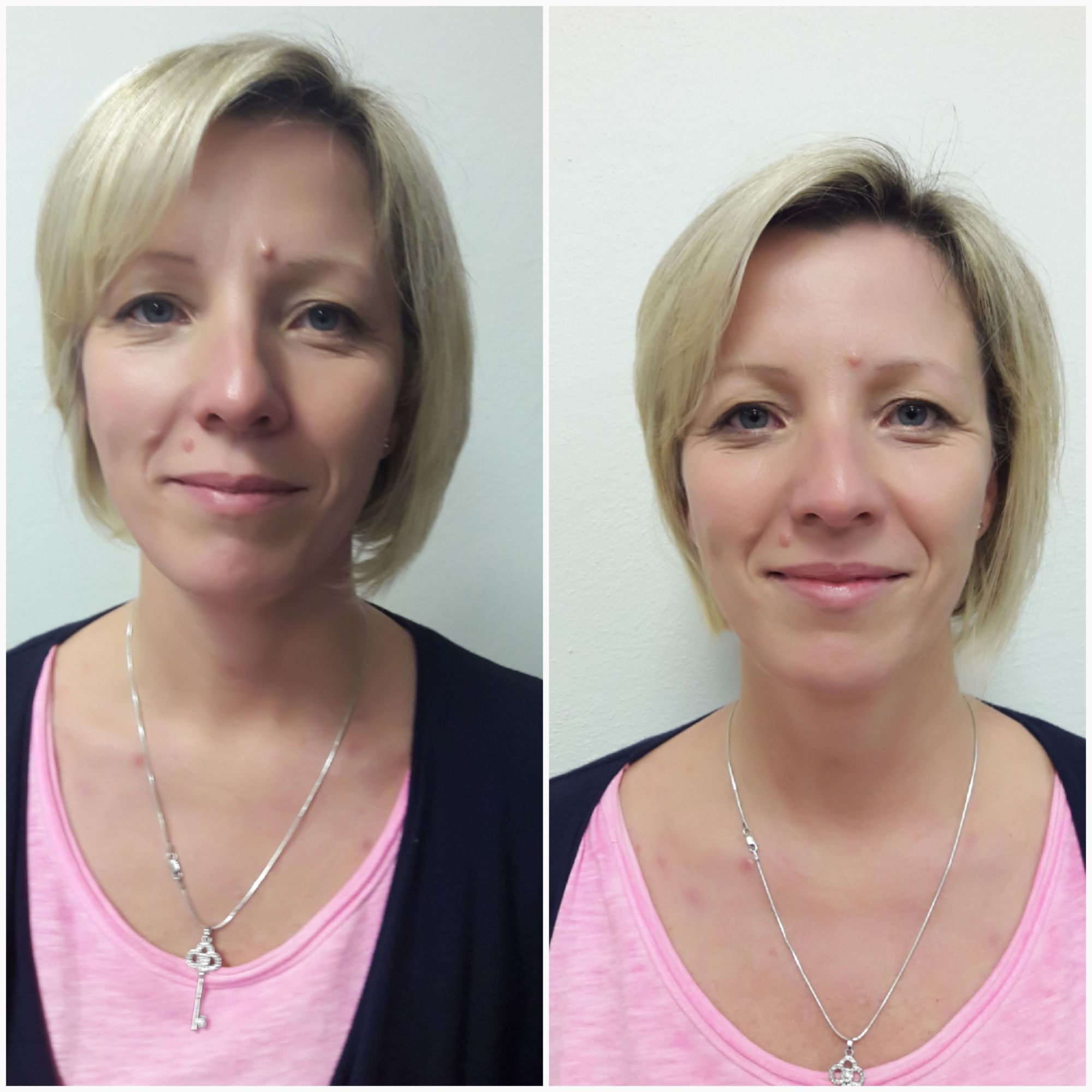 Access Facelift